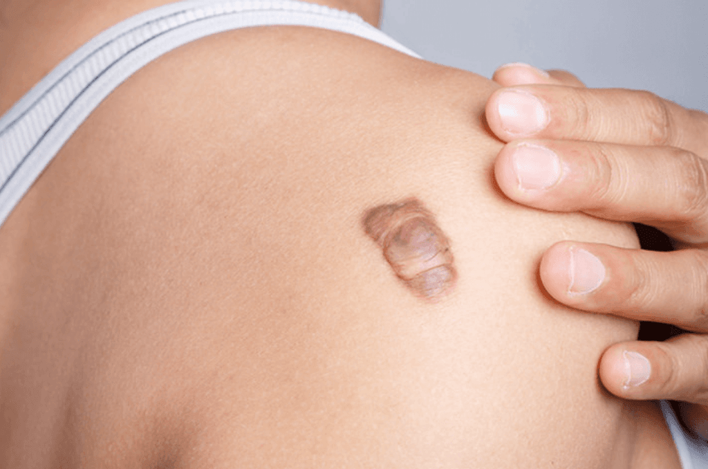 Keloid Scar Treatment By Dr Kentse Moeketsi Skin Expert Keloid Scar Treatment By Dr Kentse Moeketsi Skin Expert
